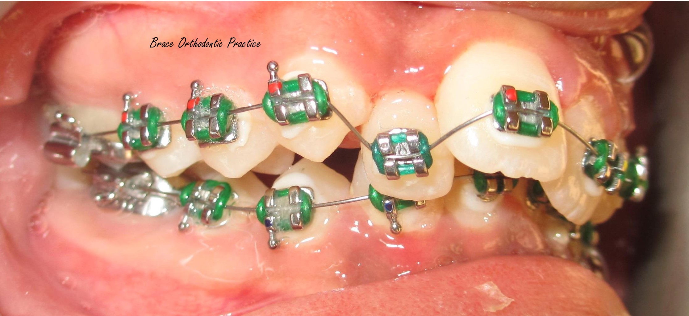 Dental Brace - Dental Care with Dr. Rahman